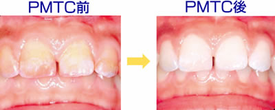 盛岡市 PMTC ゆいとぴあ歯科 | ゆいとぴあ歯科医院
